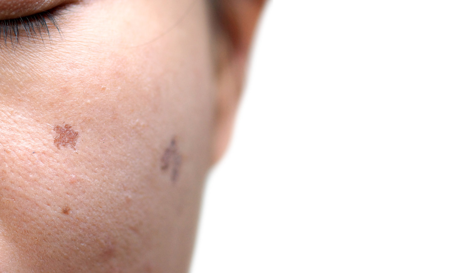 ΚΗΛΙΔΕΣ( ΠΡΟΣΩΠΟΥ , ΣΩΜΑΤΟΣ , ΔΕΡΜΑΤΟΣ) - Derma Laser & Υγεία - Χρήστος ...